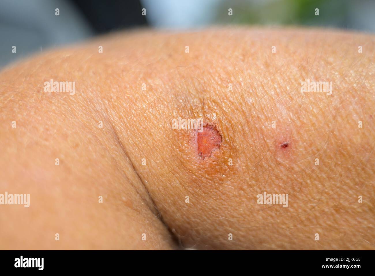 Close up detail of trauma on a persons arm with an open skin wound and ...
