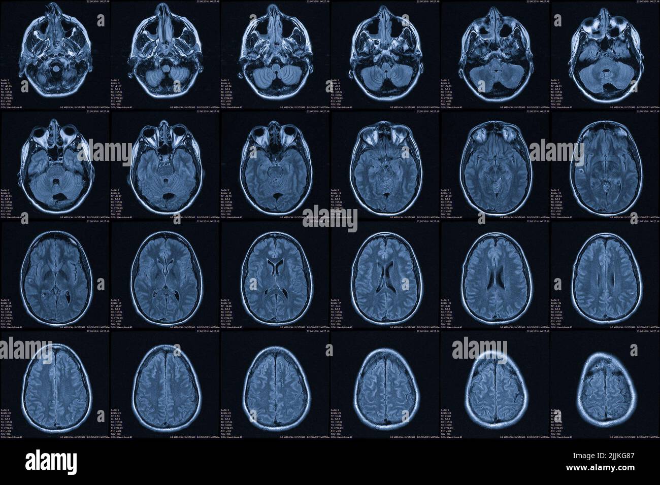 digital images of a computer tomography of a human head Stock Photo - Alamy