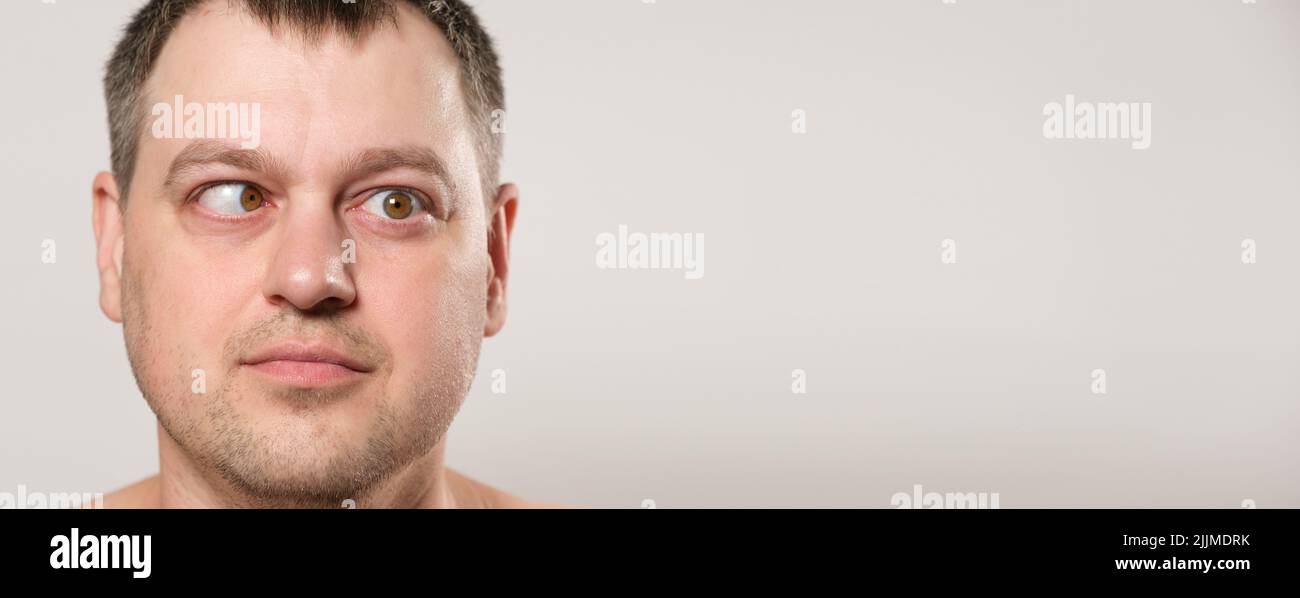 A man with strabismus squints his eyes on a white background, a banner ...
