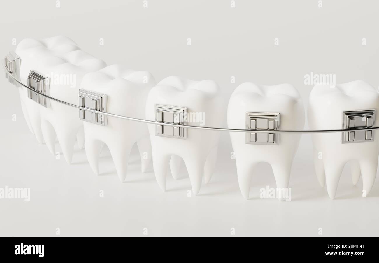 Teeth brace in the white background, 3d rendering. Computer digital ...