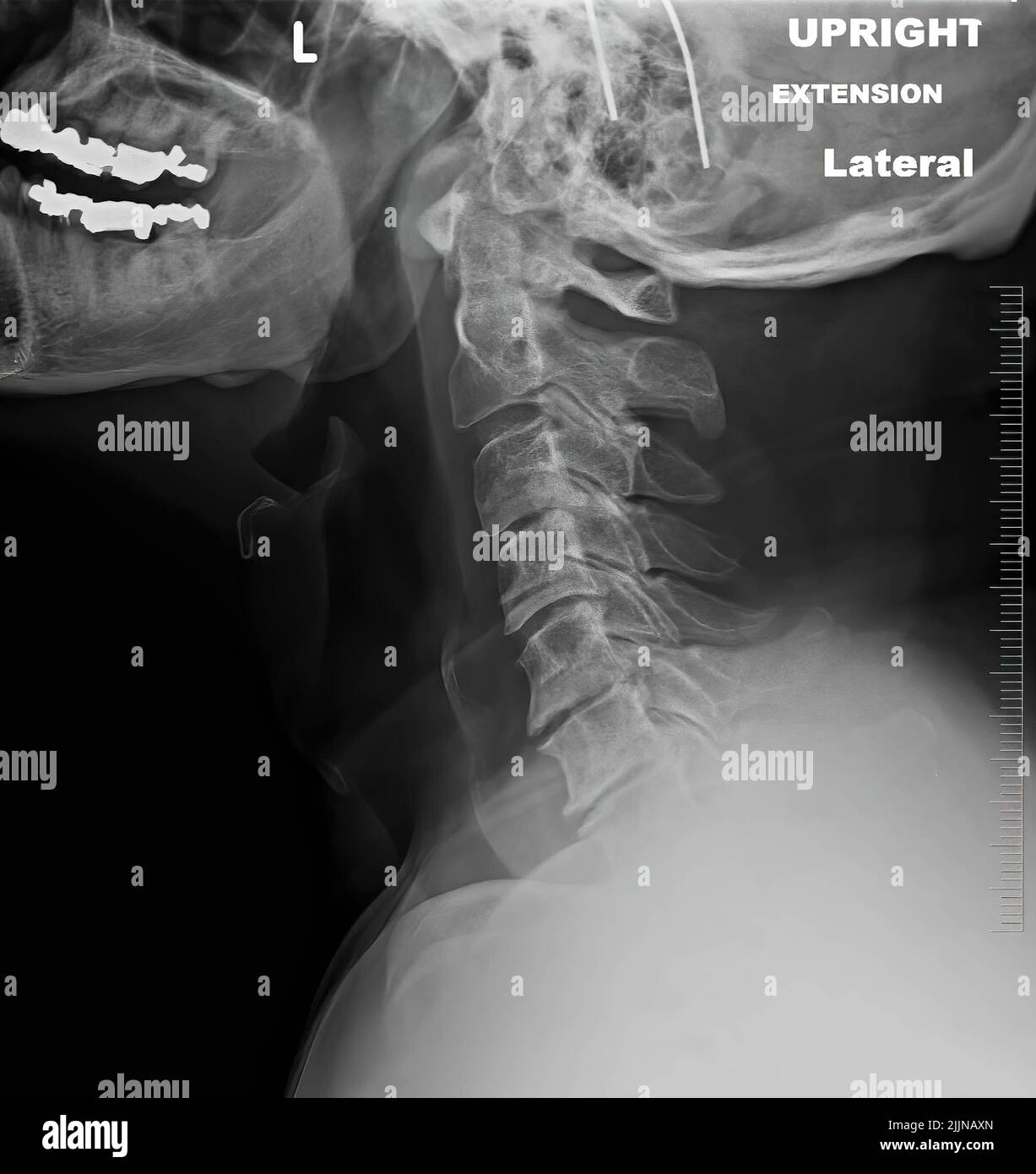 The vertical x-ray male cervical vertebrae. Medical concept Stock Photo ...