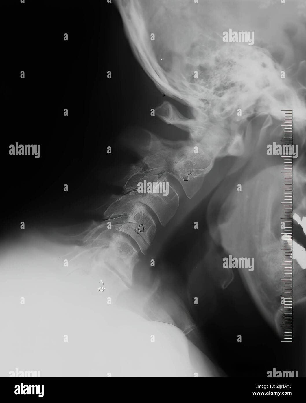 The vertical x-ray male cervical vertebrae. Medical concept Stock Photo ...