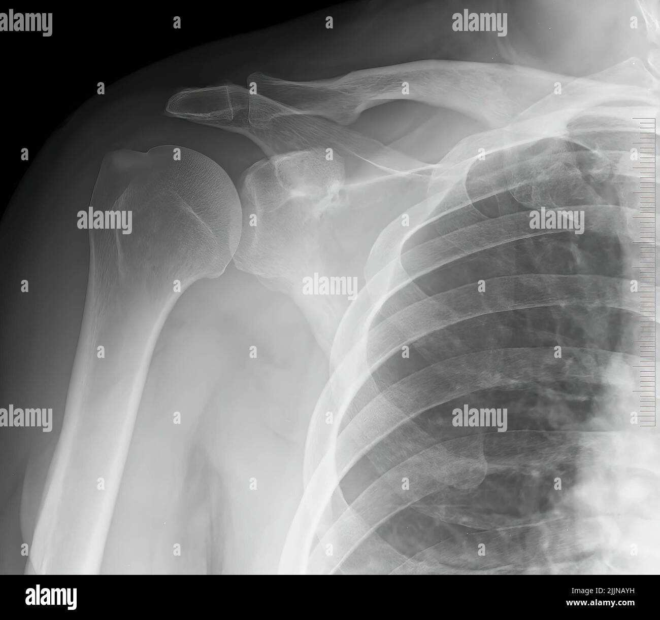 The x-ray shoulder joints. Acromioclavicular bones. Medical concept. X ...