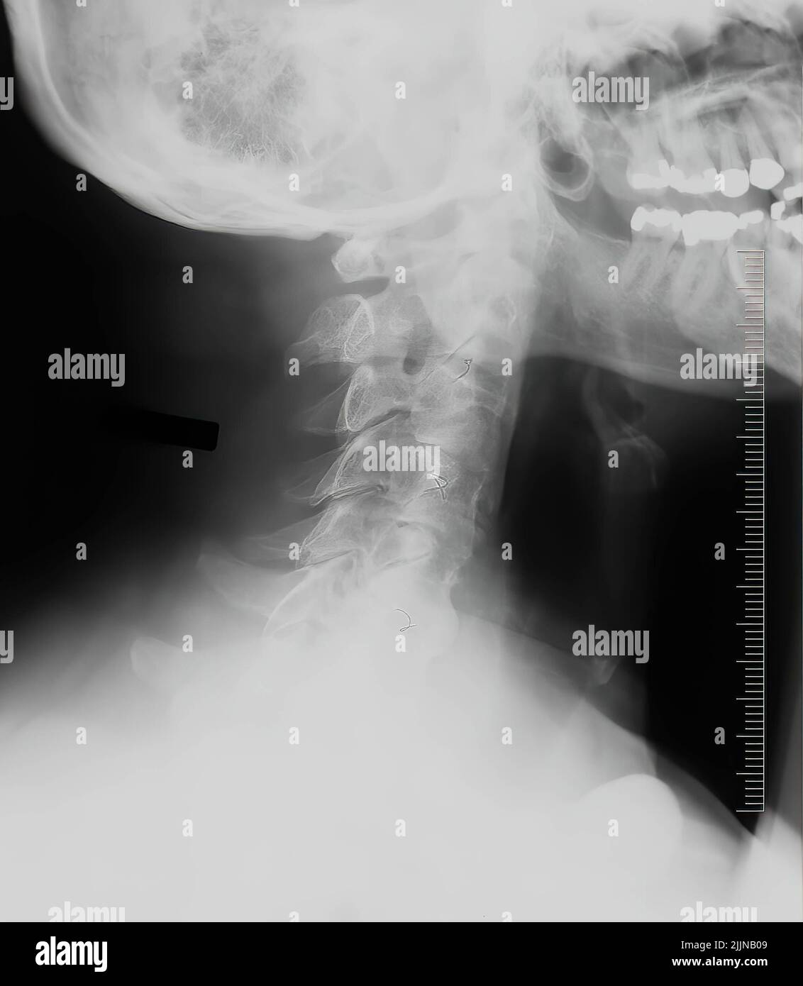 The vertical x-ray male cervical vertebrae. Medical concept Stock Photo ...