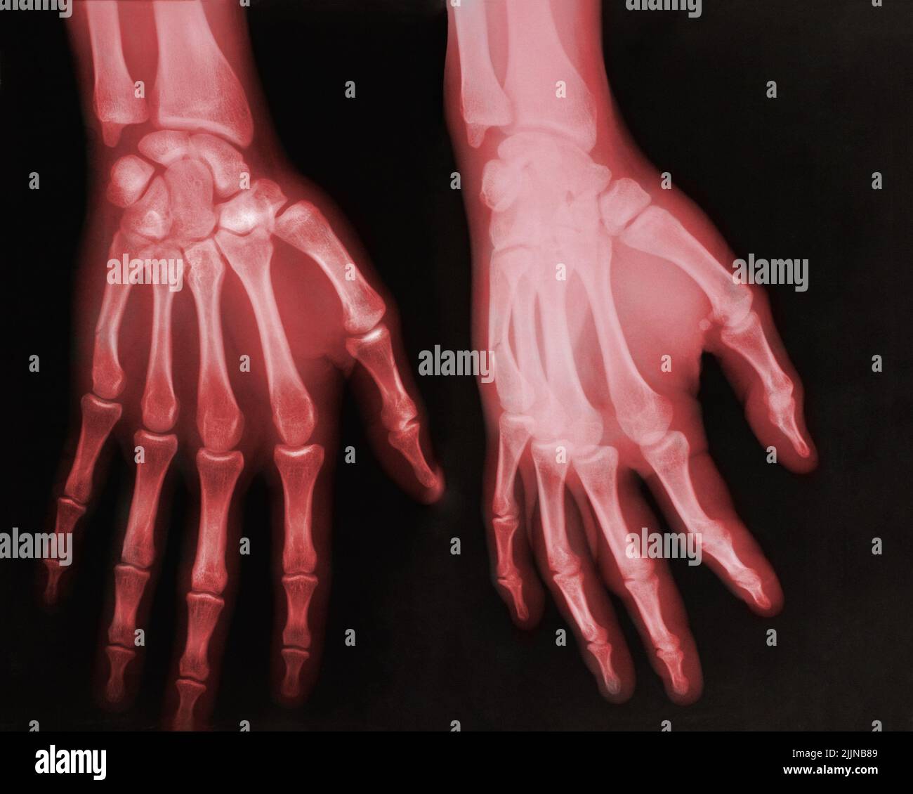 An X-ray of a left hand of an adult man with visible damage Stock Photo ...
