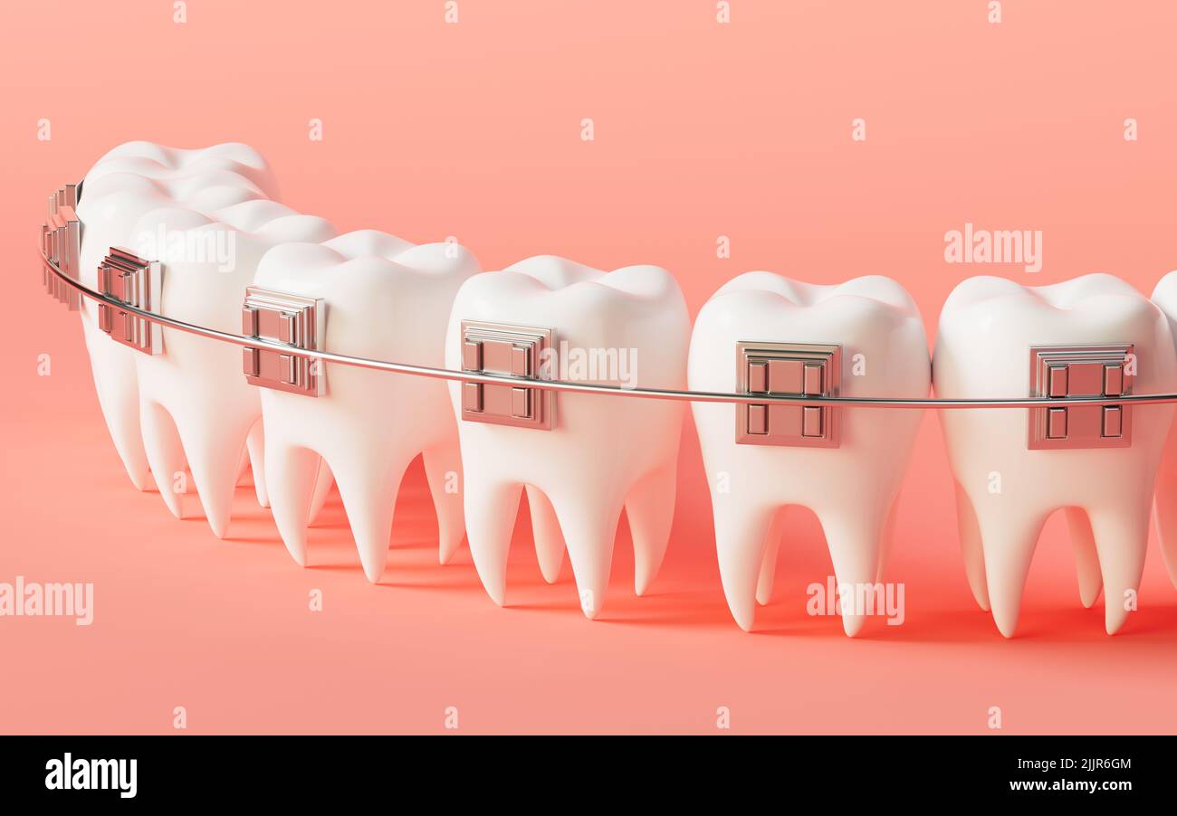 Teeth brace in the pink background, 3d rendering. Computer digital ...