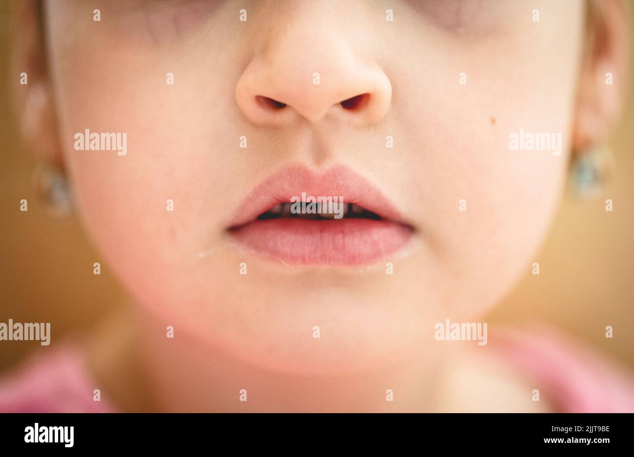A closeup of a young girl's face with the decayed teeth seen through ...