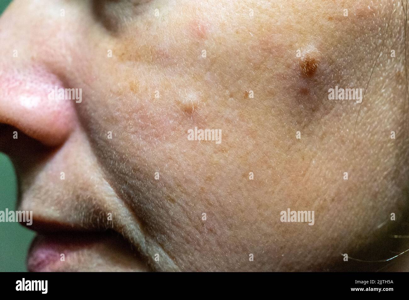 Close-up of a woman's cheek with problem skin Stock Photo - Alamy
