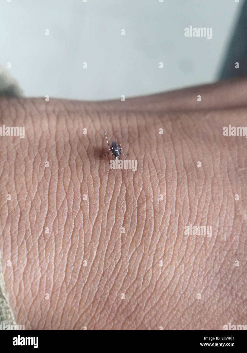 Dangerous Malaria Infected Mosquito Skin Bite. Leishmaniasis ...