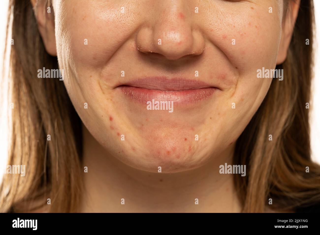 Young smiling woman with the pimples on her face. Problematic skin ...