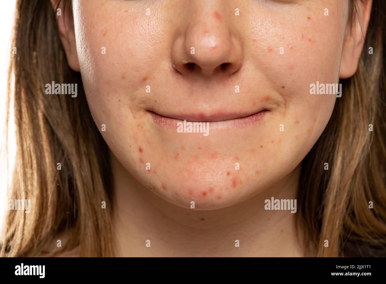 Young woman with the pimples on her face. Problematic skin. Close-up ...