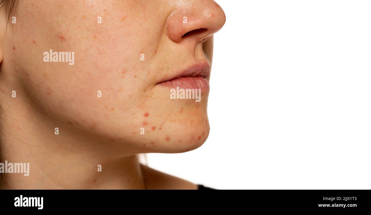 Young woman with the pimples on her face. Problematic skin. Close-up ...