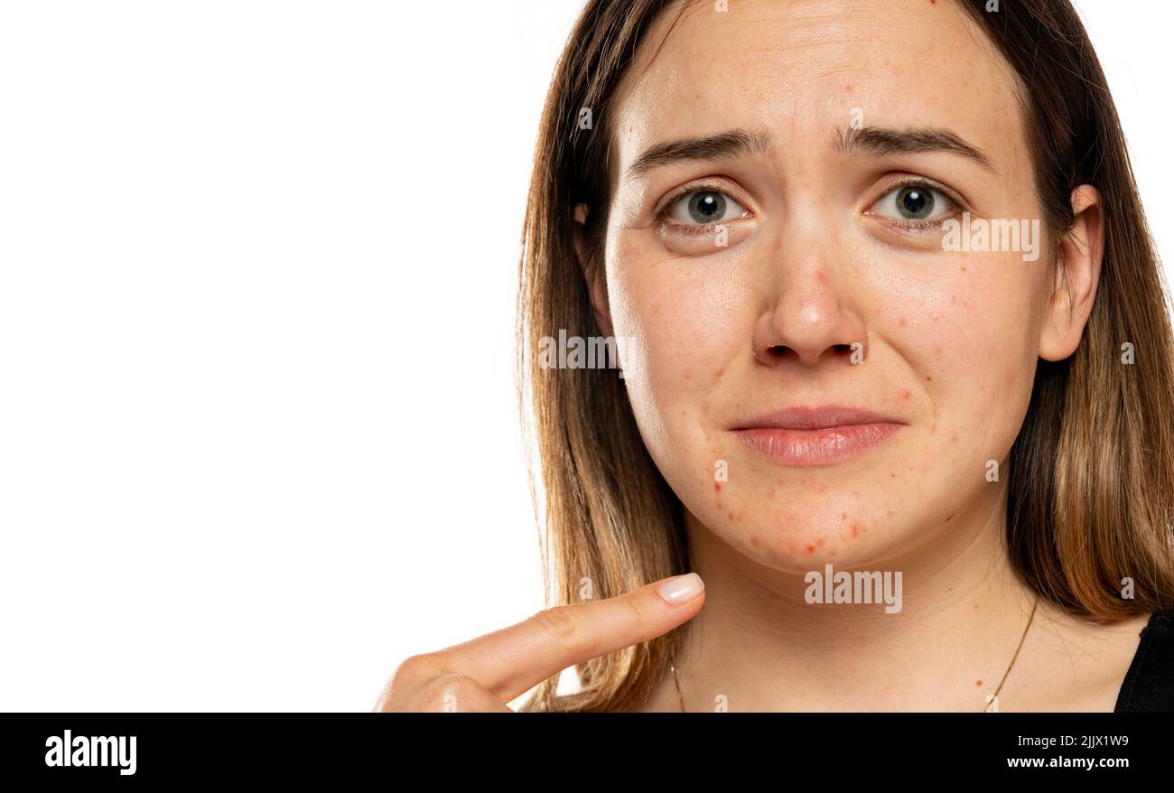Young unhapy woman with the pimples on her face. Problematic skin Stock ...