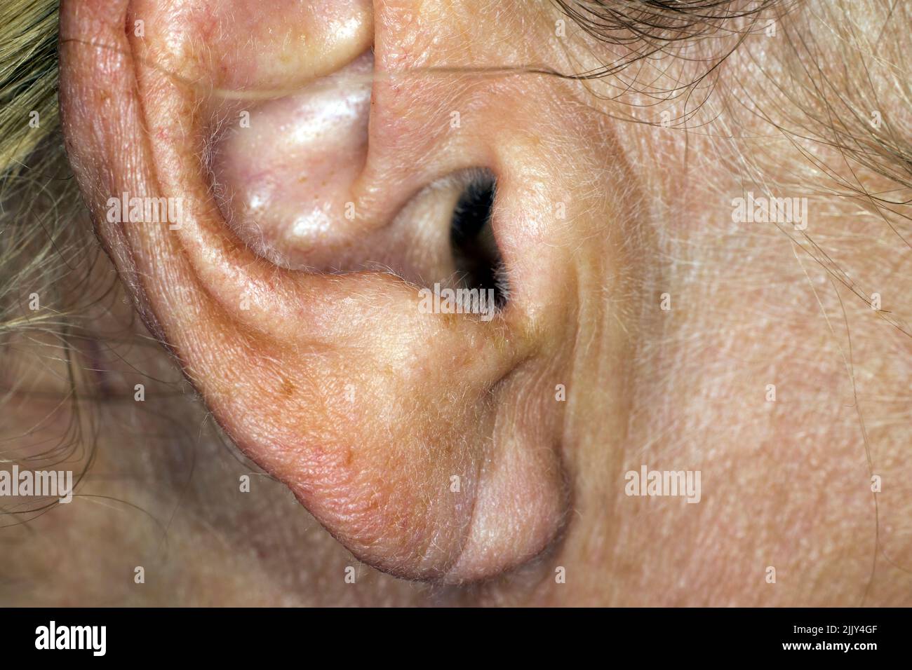 Acute ear hi-res stock photography and images - Alamy