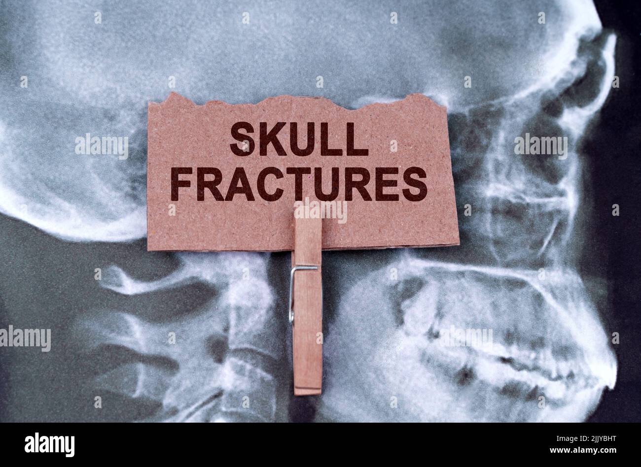 Medicine concept. Against the background of an X-ray of the skull, a ...