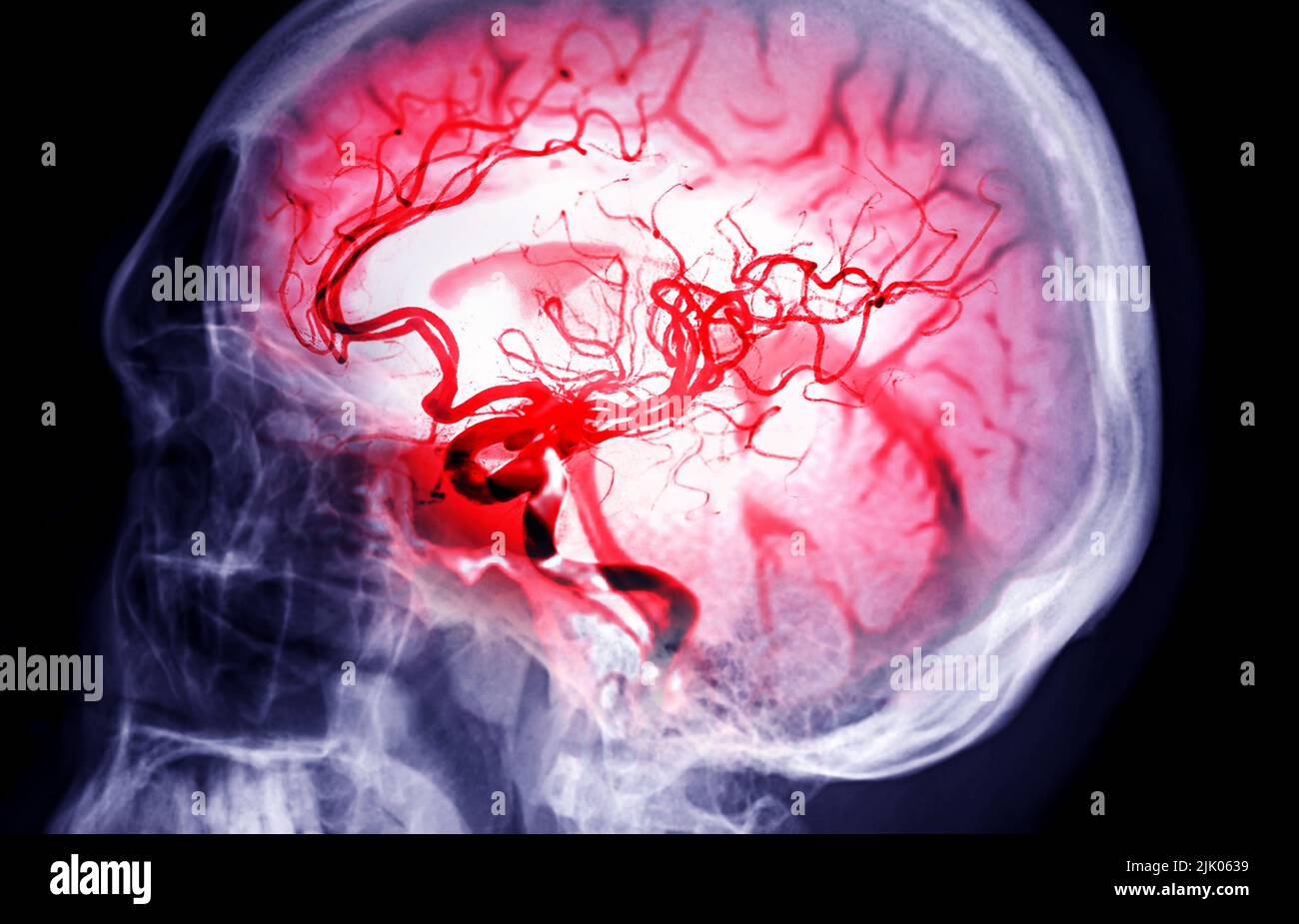 Skull image fusion with MRI MRA Brain for evaluate them stenosis and ...