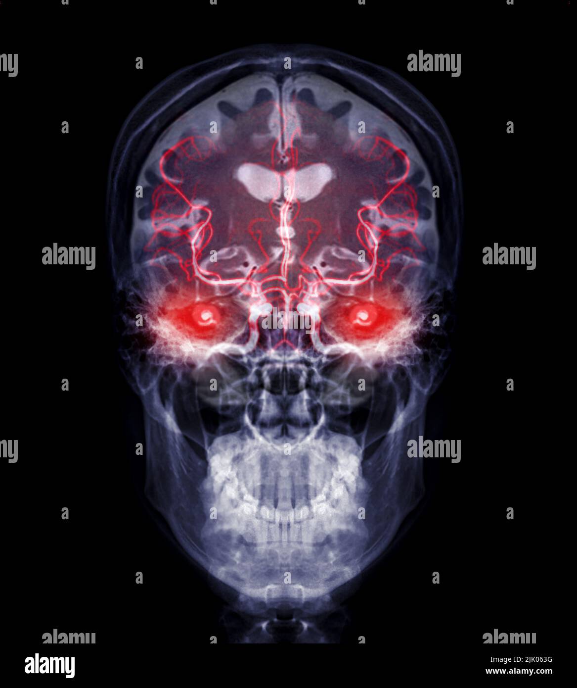 Skull image fusion with MRI MRA Brain for evaluate them stenosis and ...