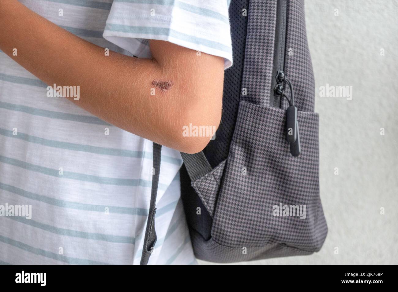 Healing wound on child hand. Deep scratches on teenage boy elbow hand ...