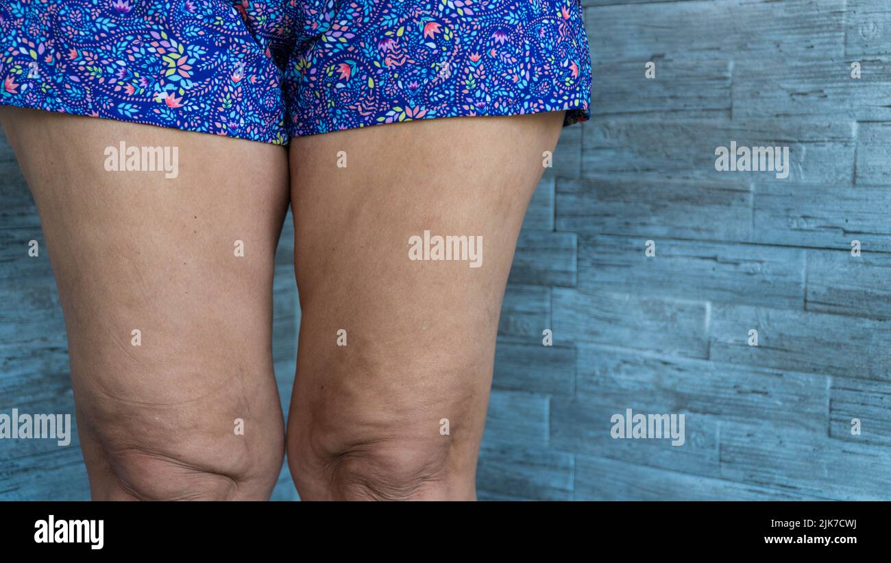 Hip body part hi-res stock photography and images - Alamy