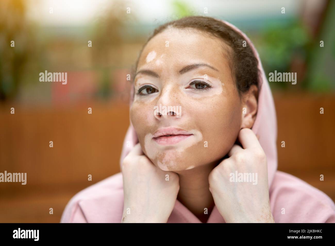 Black african american woman with vitiligo pigmentation skin problem ...