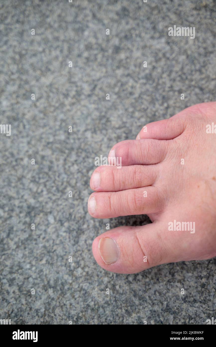 Broken toe hi-res stock photography and images - Alamy