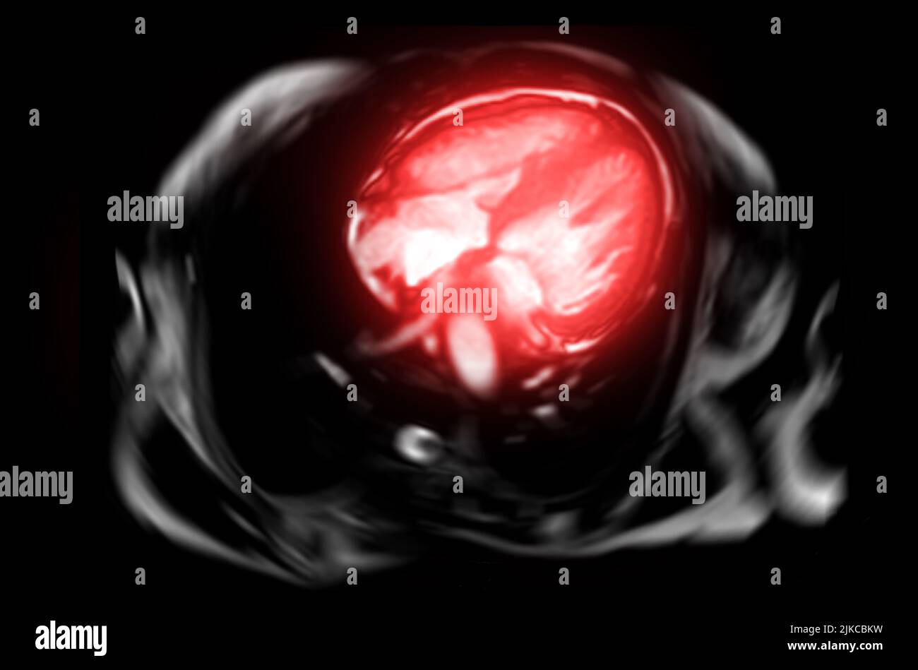 MRI heart or Cardiac MRI ( magnetic resonance imaging ) of heart in ...