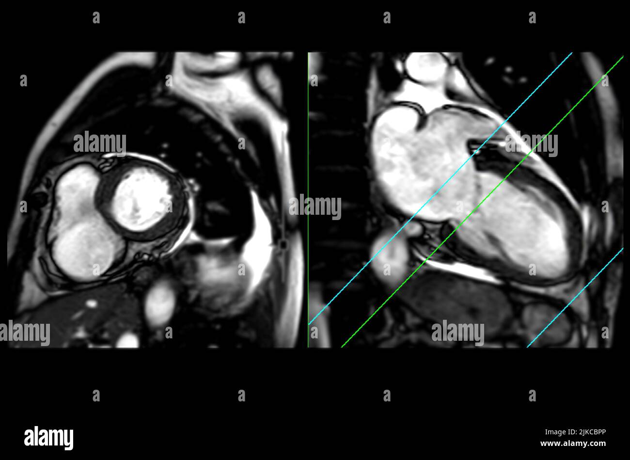 Mri Heart Or Cardiac Mri Magnetic Resonance Imaging Of Heart In Short Axis And Vertical Long