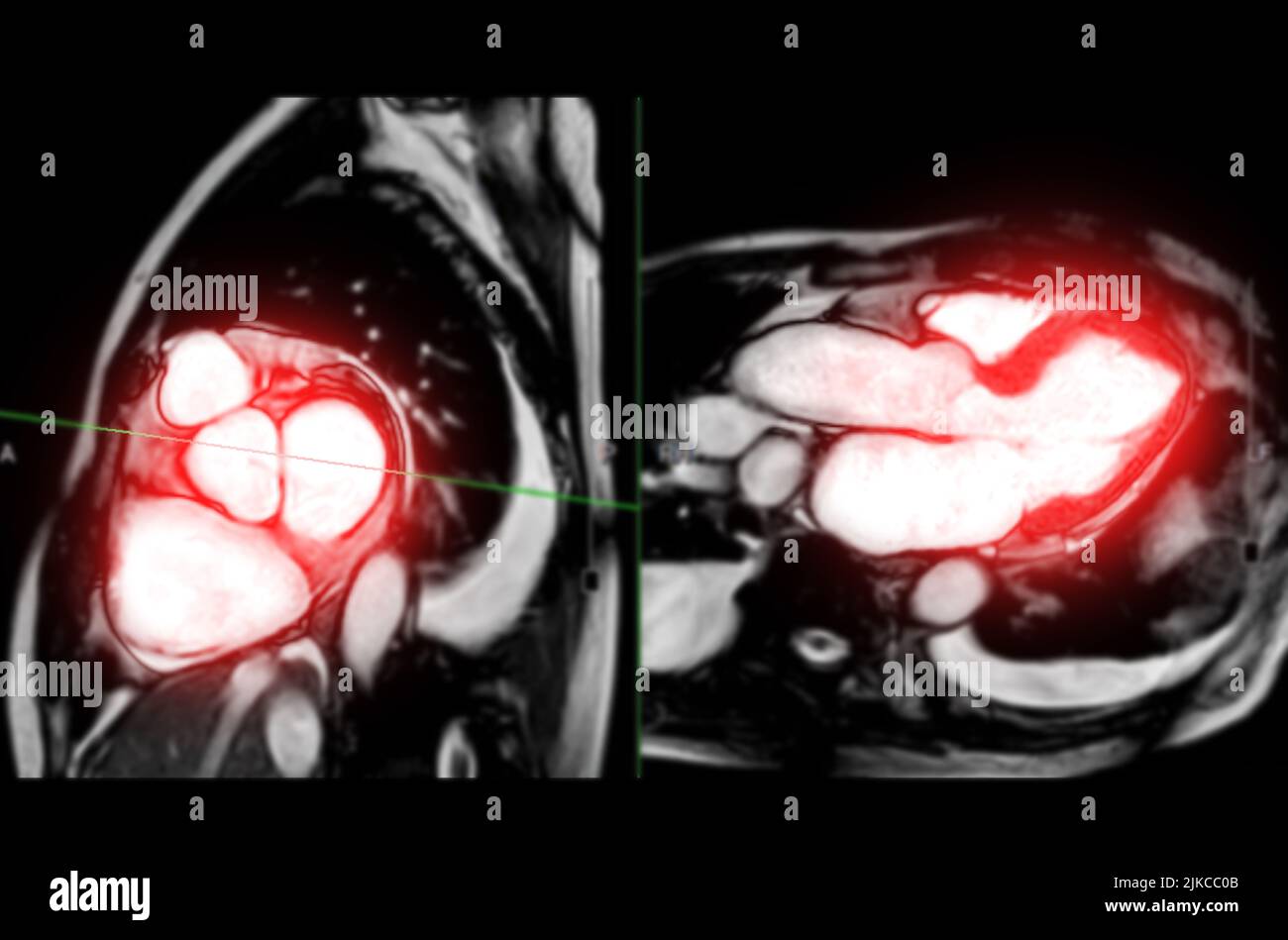 Mri Heart Or Cardiac Mri Magnetic Resonance Imaging Of Heart In Short Axis And Vertical Long