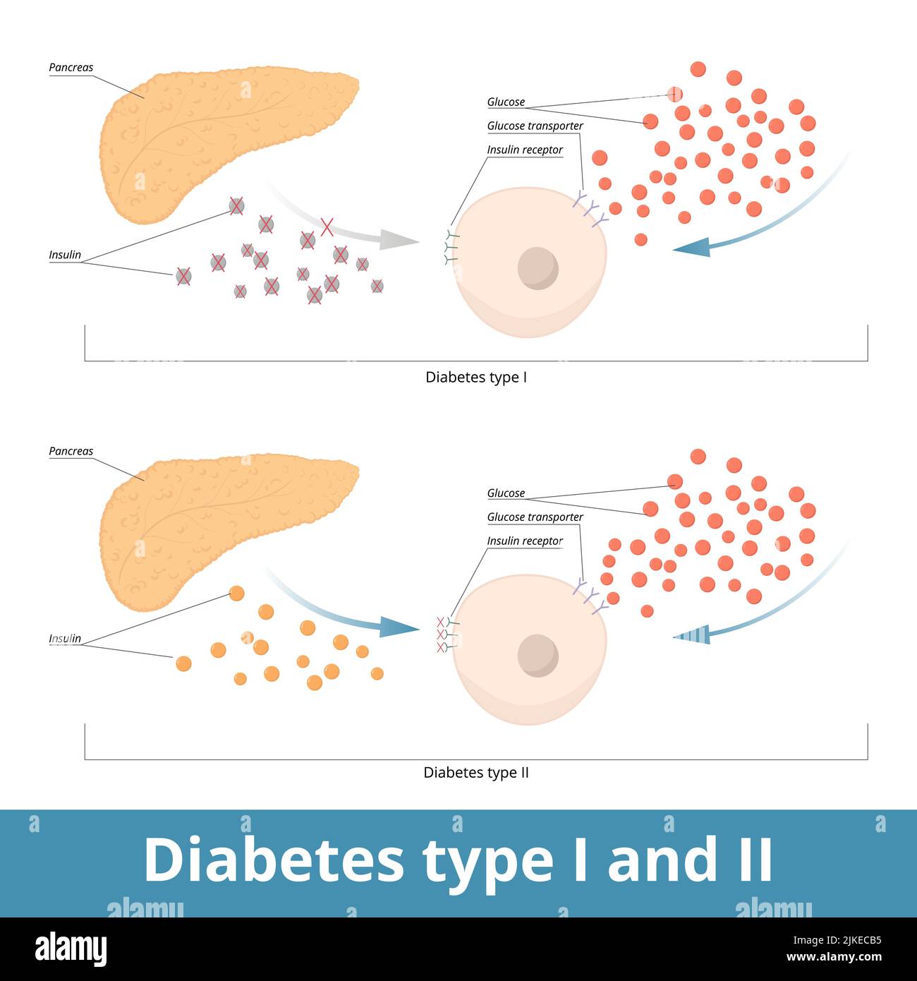 Diabetes type I and II. Schematic visualization of two diabetes types ...