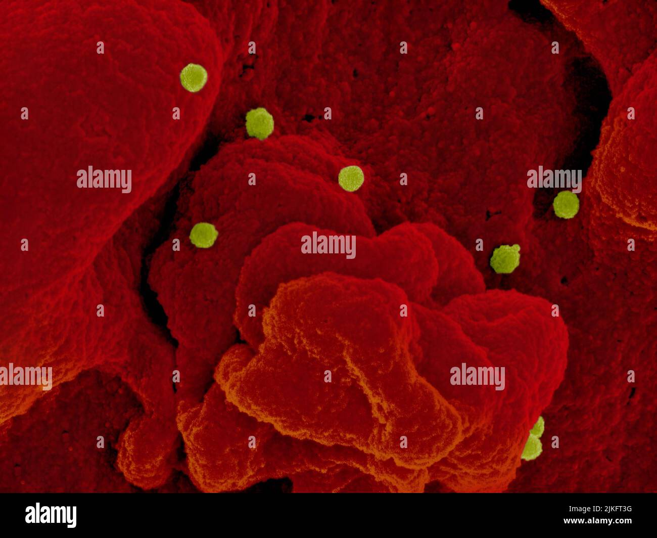 Scanning electron micrograph of Crimean-Congo hemorrhagic fever (CCHF ...