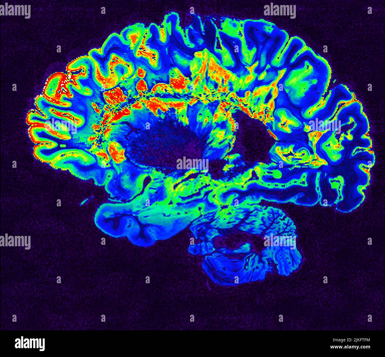 This is a pseudo-colored image of a high resolution gradient echo MRI ...