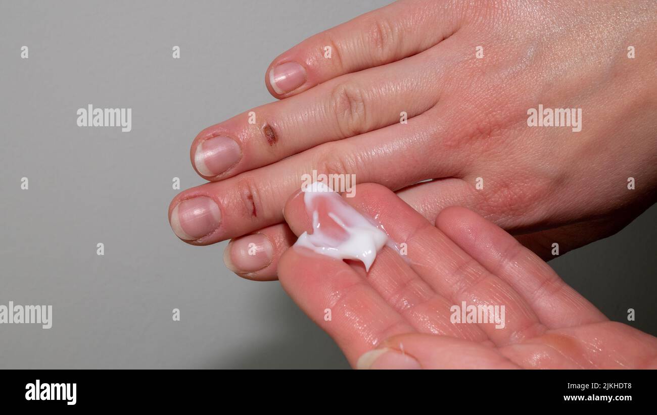 Cream cures burns, First aid, scalded wound, Applying healing cream on ...