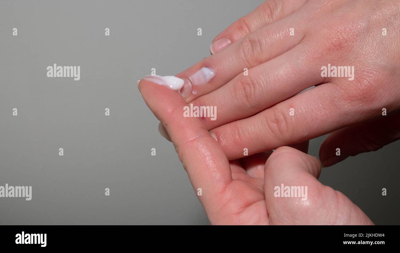 Cream cures burns, First aid, scalded wound, Applying healing cream on ...