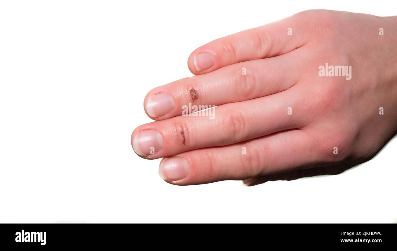 Cream cures burns, First aid, scalded wound, Applying healing cream on ...