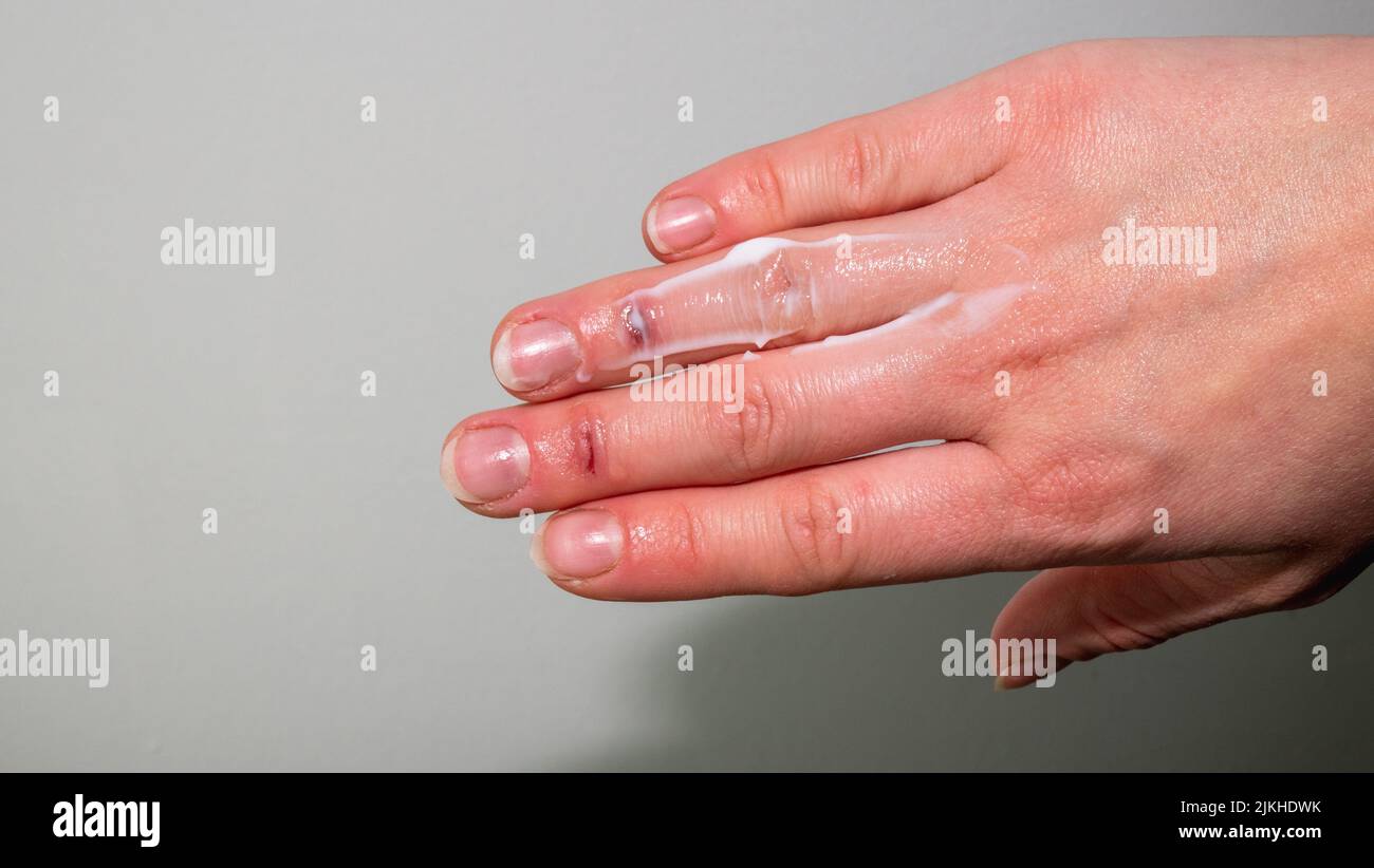 Burn scar hand hi-res stock photography and images - Alamy