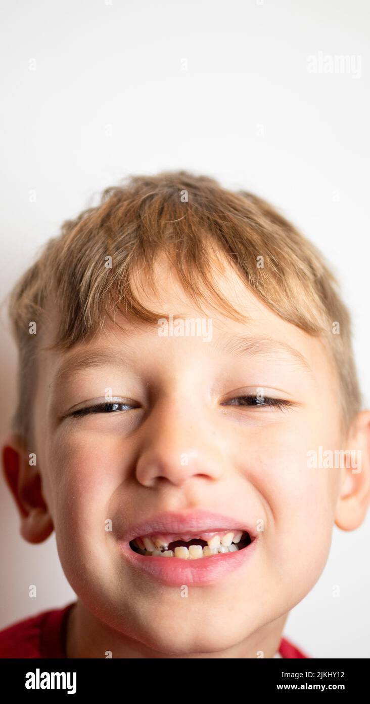 portrait of a boy with bad teeth, fallen front upper teeth Stock Photo ...