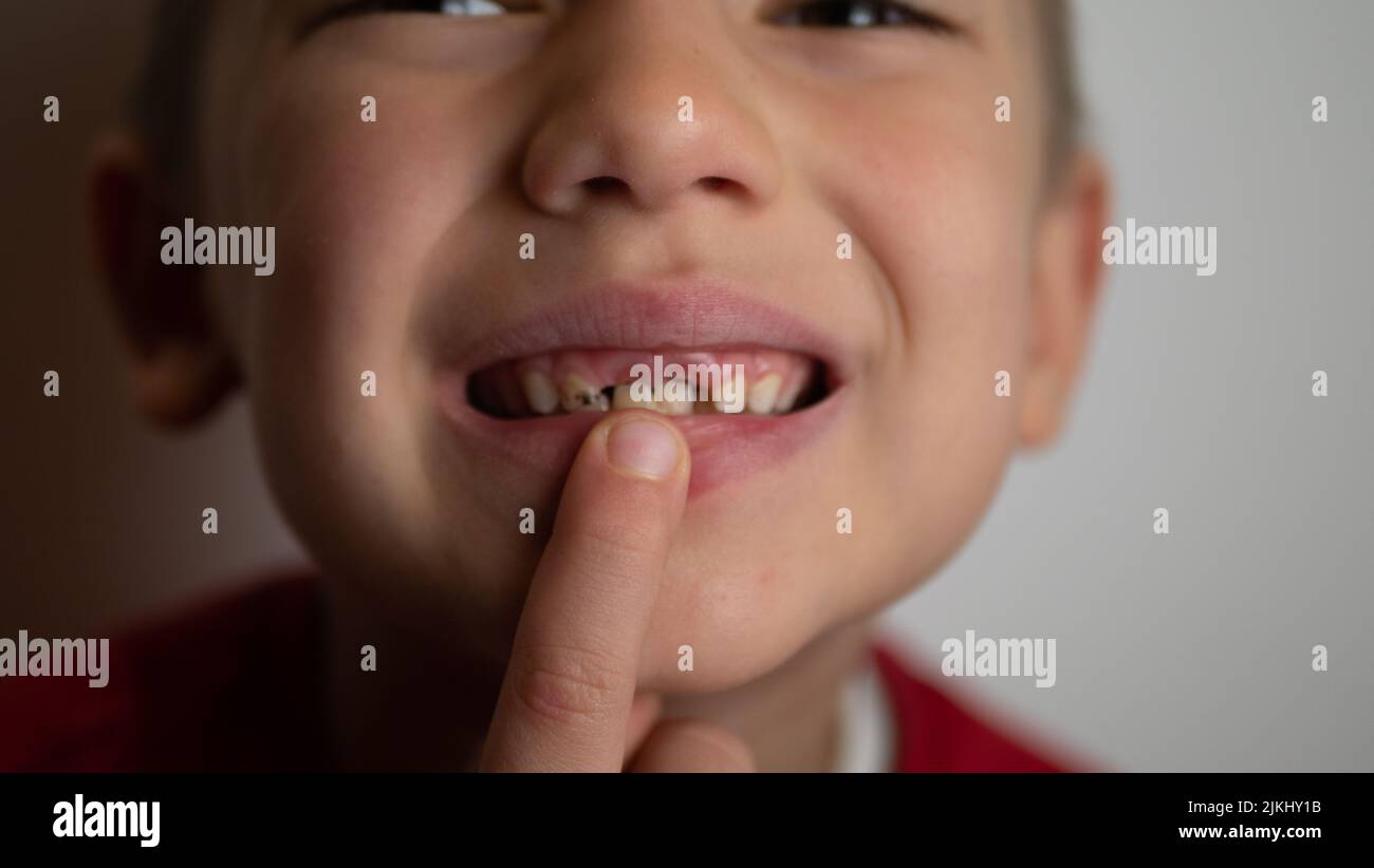 portrait of a boy with bad teeth, fallen front upper teeth Stock Photo ...