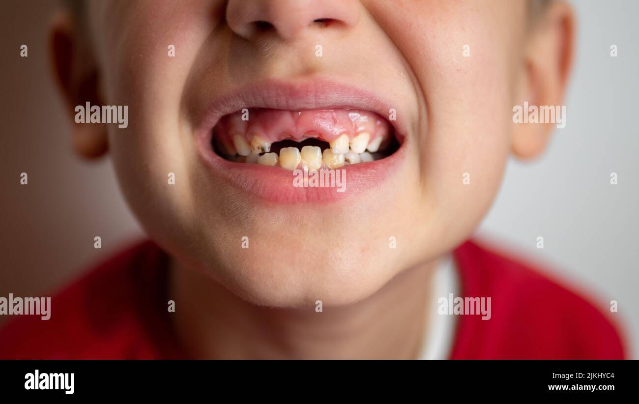 portrait of a boy with bad teeth, fallen front upper teeth Stock Photo ...