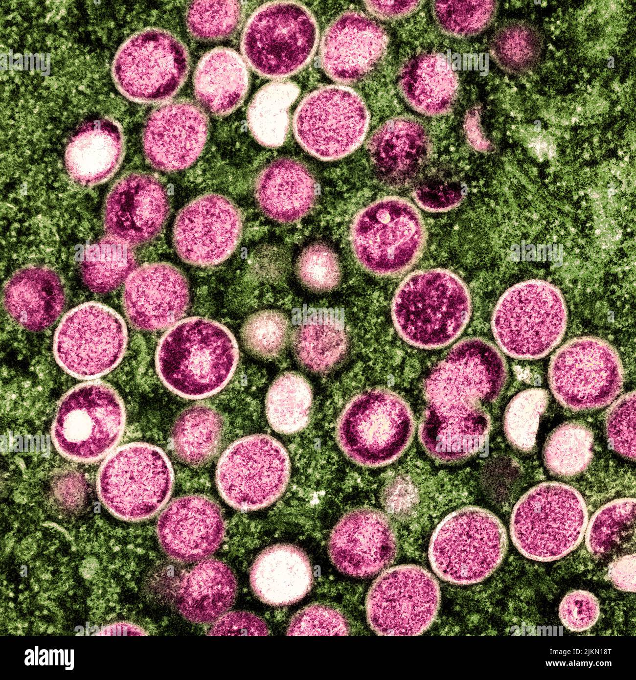 Monkeypox Virus Colorized transmission electron micrograph of monkeypox ...