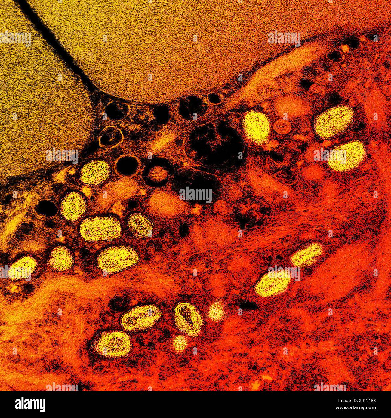 Monkeypox Virus Colorized transmission electron micrograph of monkeypox ...