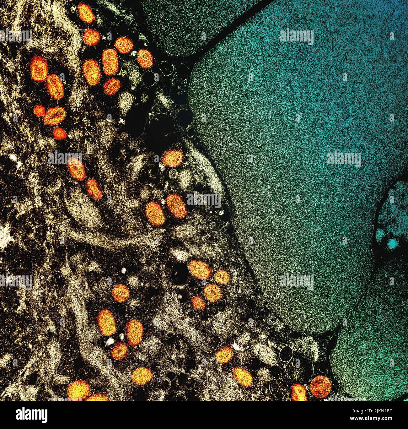 Monkeypox Virus Colorized transmission electron micrograph of monkeypox ...