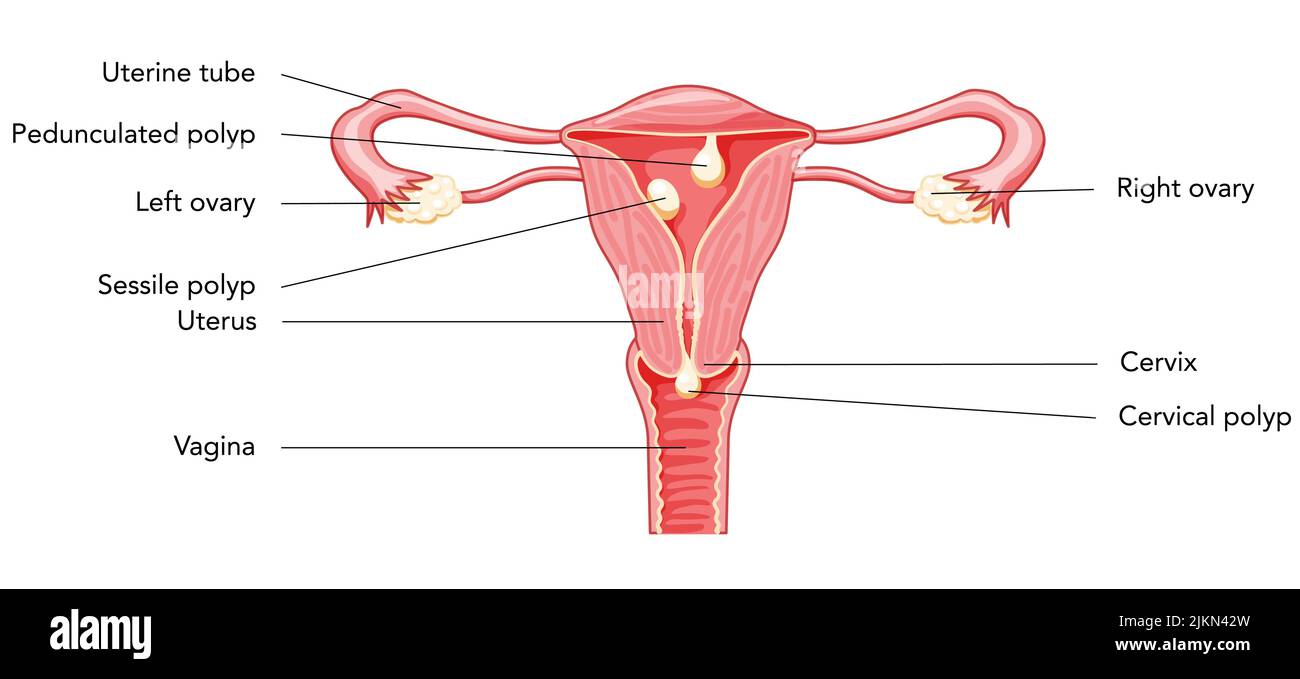 Polyp In The Uterus With Inscriptions Diagram Female Reproductive