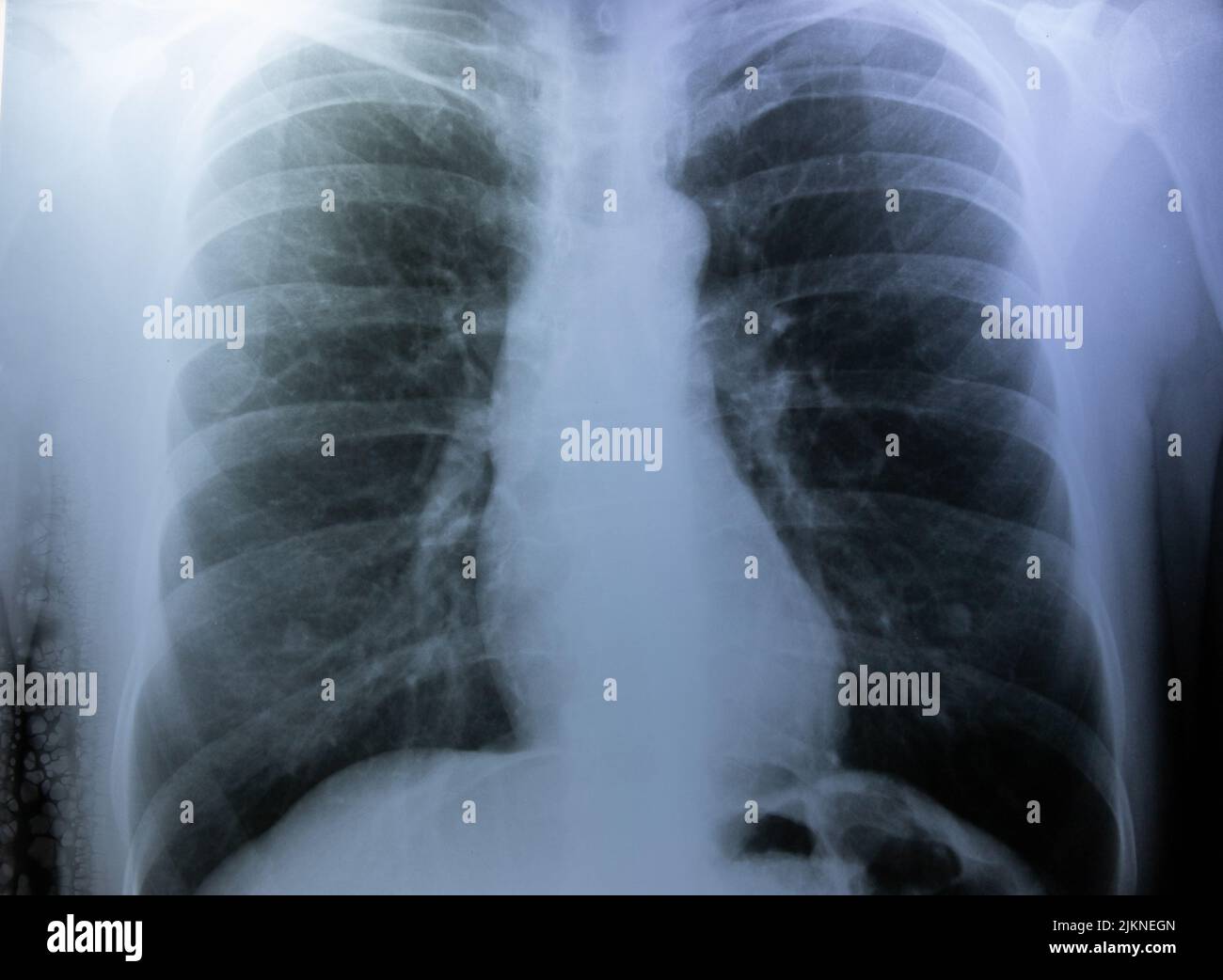 Normal chest x ray hi-res stock photography and images - Alamy