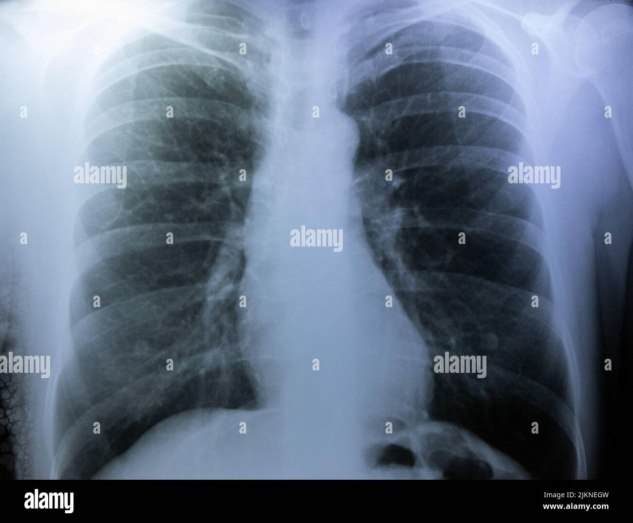 a chest x-ray of a person in closeup Stock Photo - Alamy