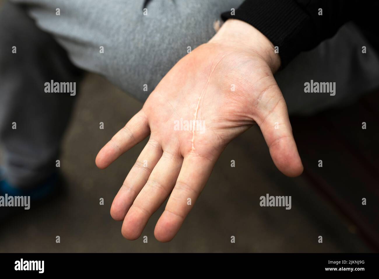 Scar hand hi-res stock photography and images - Alamy