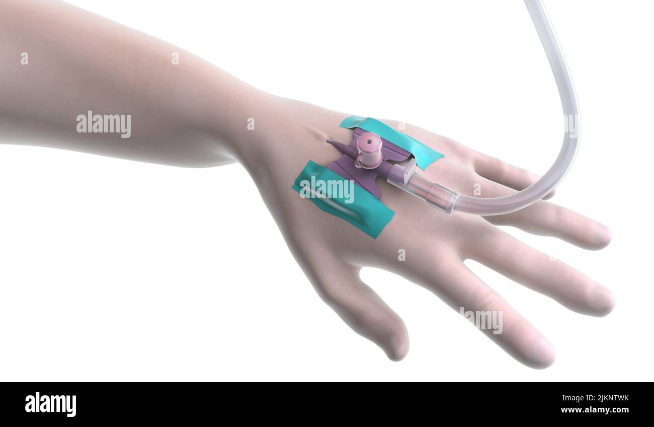 Intravenous access hand, illustration Stock Photo - Alamy
