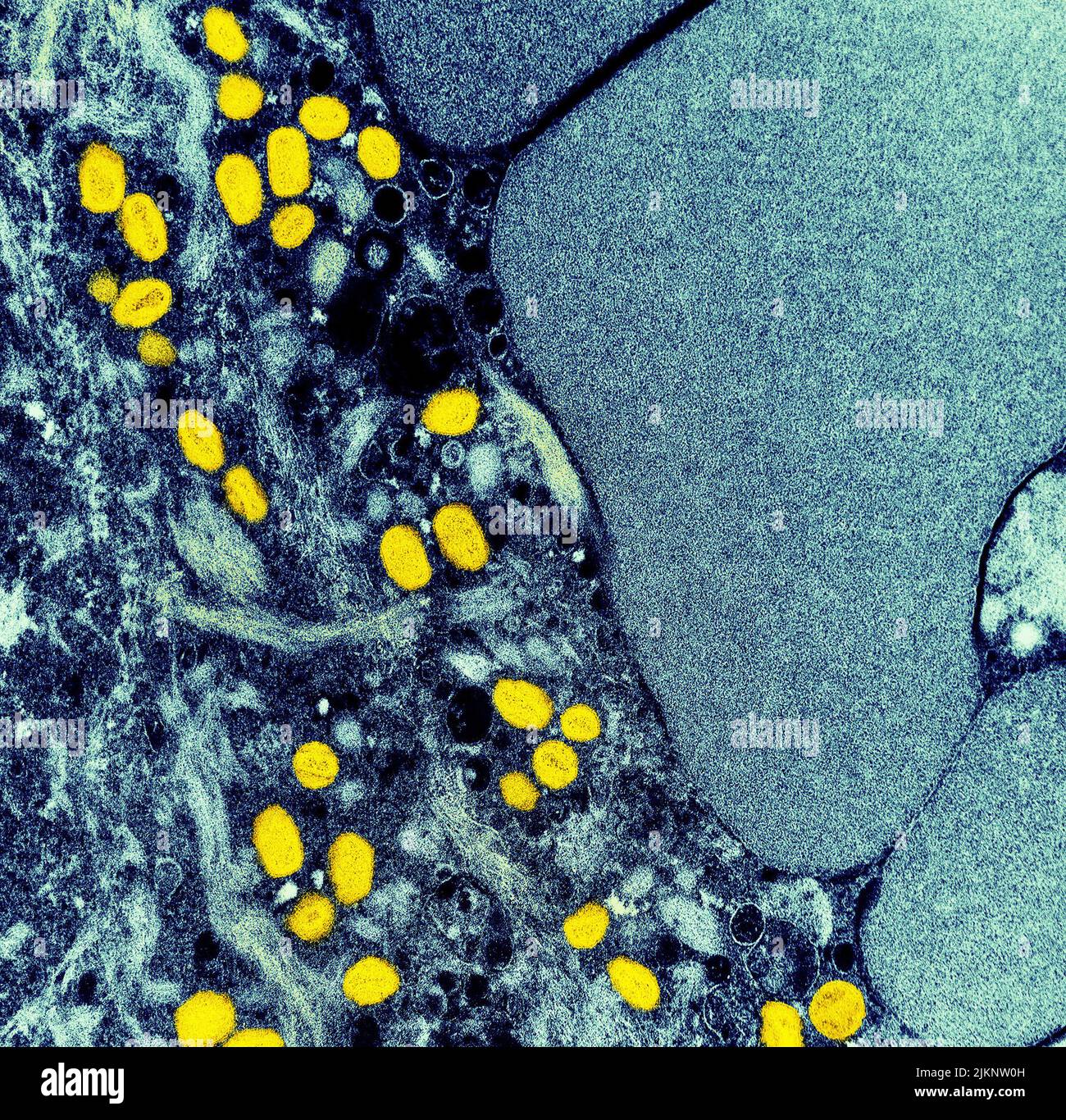 Monkeypox virus particles, TEM Stock Photo - Alamy