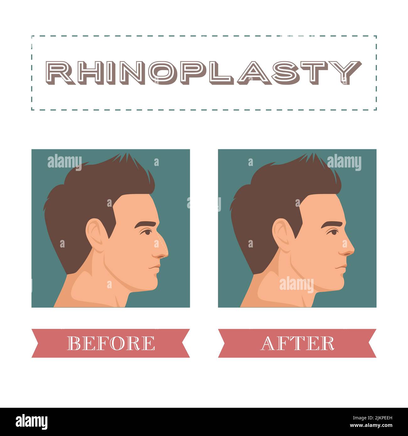Rhinoplasty concept vector illustration, cosmetic nose surgery ...