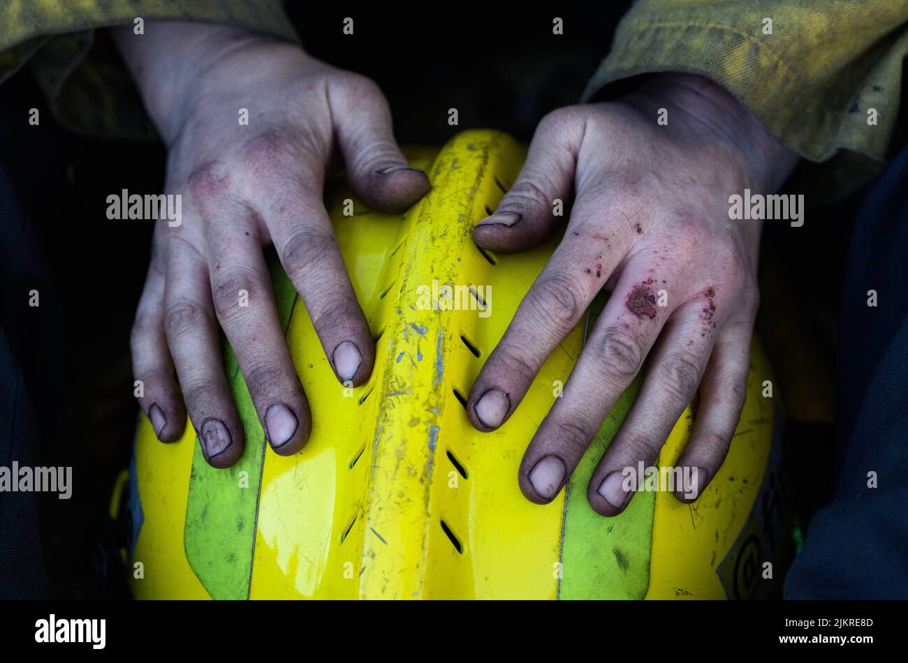 Bad Schandau, Germany. 03rd Aug, 2022. The hands with burns of Julia ...