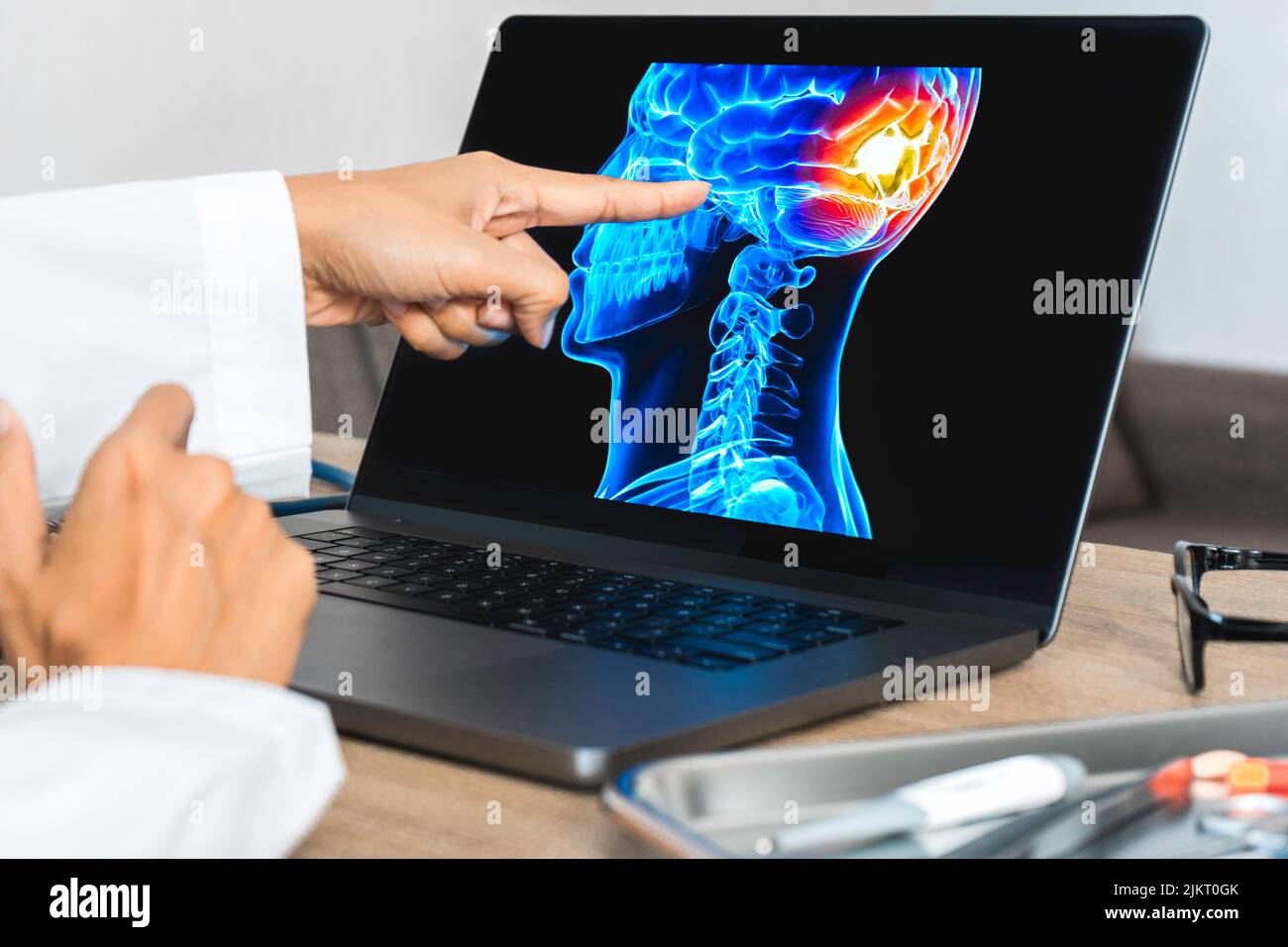 Doctor showing a x-ray of pain in the brain on a laptop. Migraine ...